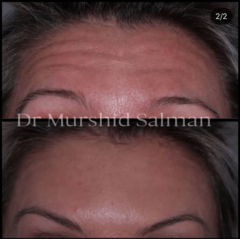 Botox in Kent by Dr Murshid Salman - Fine Art Aesthetics